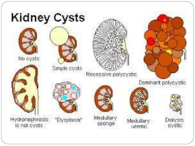 Intra abdominal cysts in children | PPTX