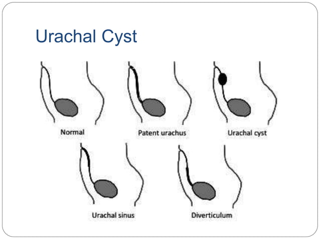 Intra abdominal cysts in children | PPTX