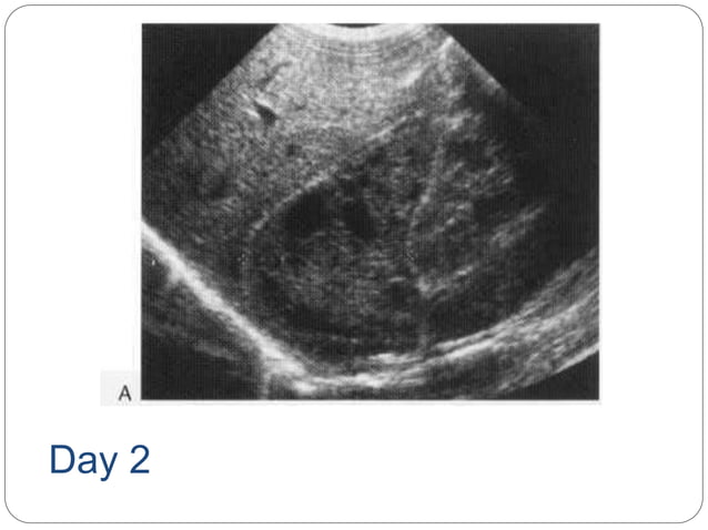 Intra abdominal cysts in children | PPTX