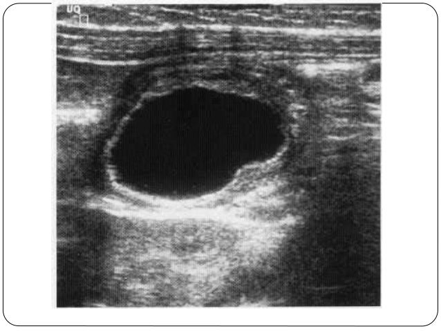 Intra abdominal cysts in children