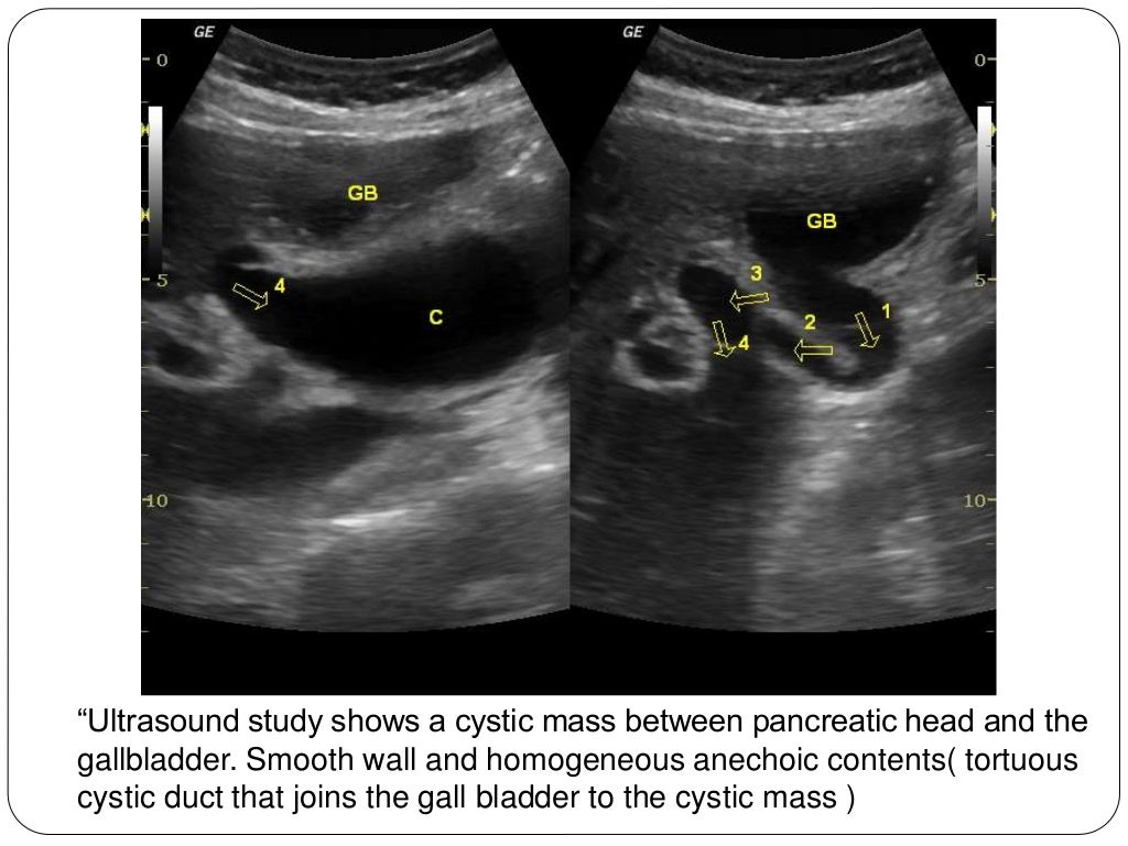 Intra abdominal cysts in children