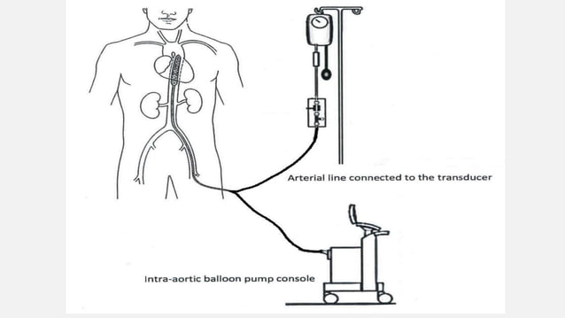 Intra aortic balloon pump and ECMO | PPTX