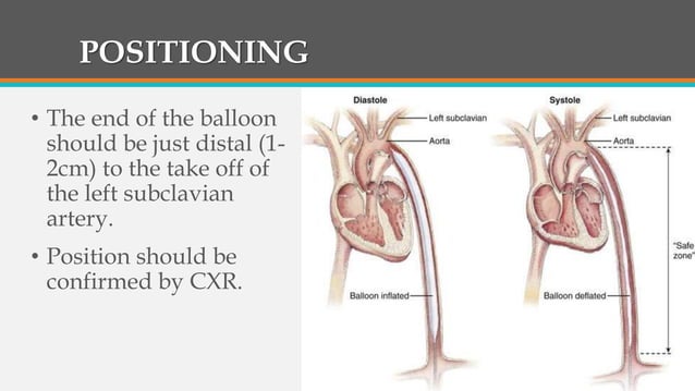 Intra aortic balloon pump and ECMO | PPTX