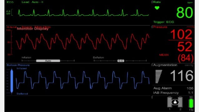Intra aortic balloon pump and ECMO