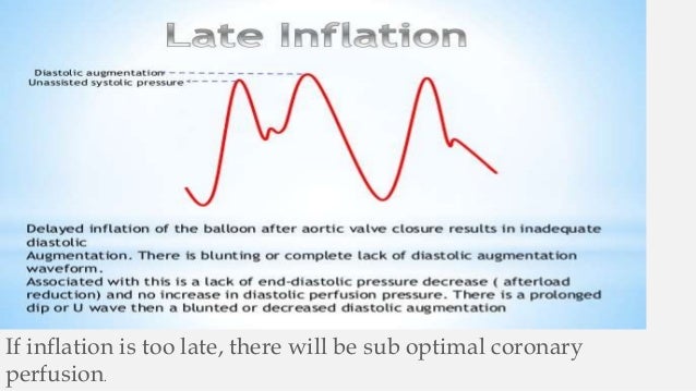 Intra aortic balloon pump and ECMO