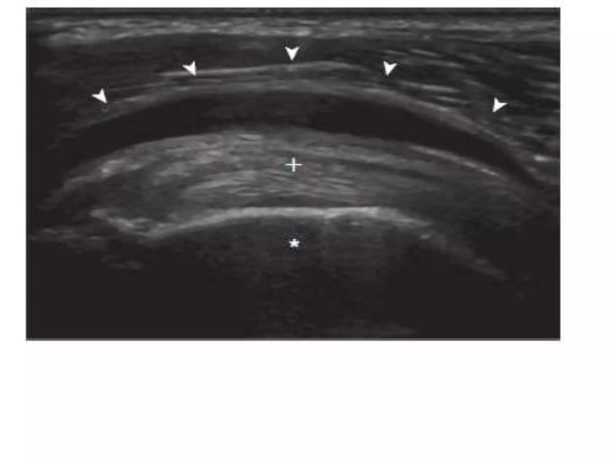 Intra articular injection by dr. ahmed shedeed | PPTX
