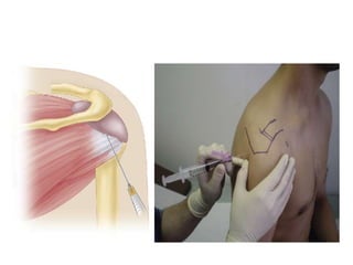 Intra articular injection by dr. ahmed shedeed | PPTX