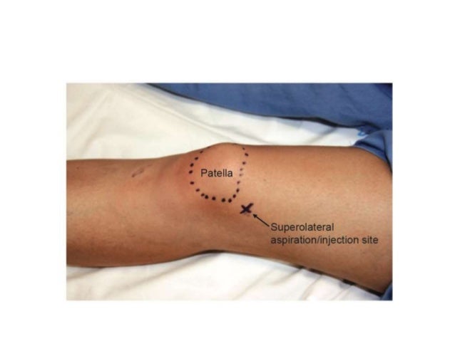 Intraarticular Steroid Injection