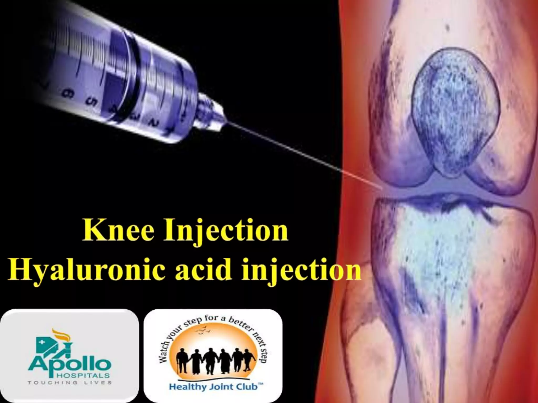 Intraartiular knee injection | PPTX