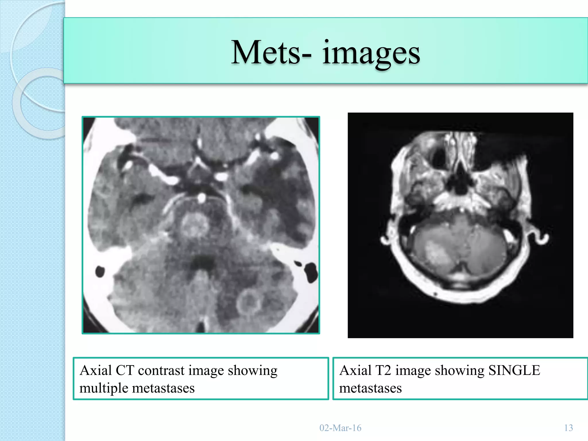 Intra axial posterior fossa tumor | PPTX