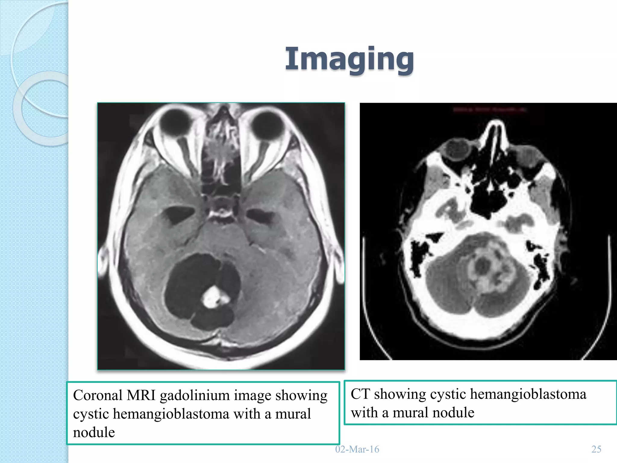 Intra axial posterior fossa tumor | PPTX