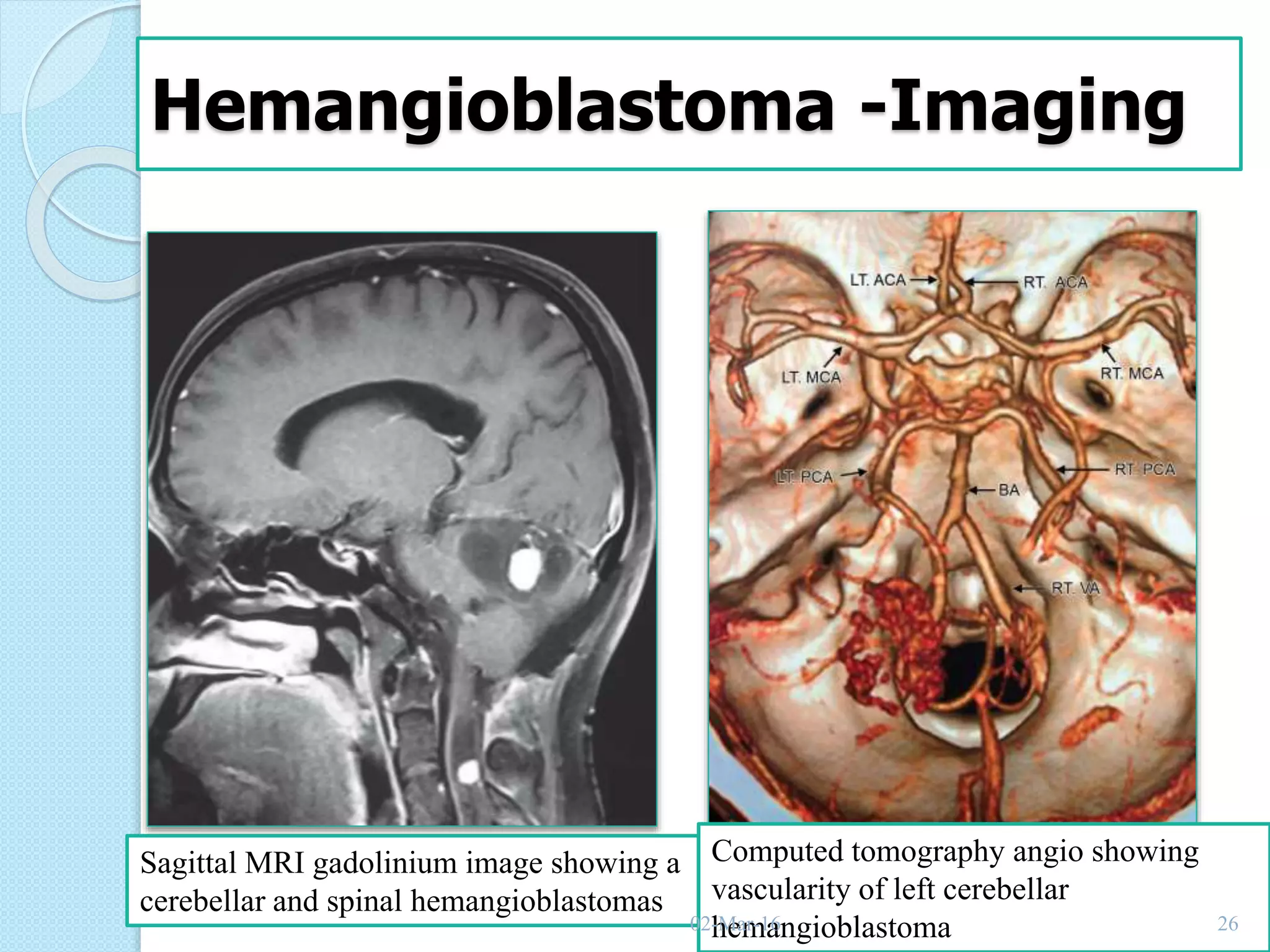 Intra axial posterior fossa tumor | PPTX