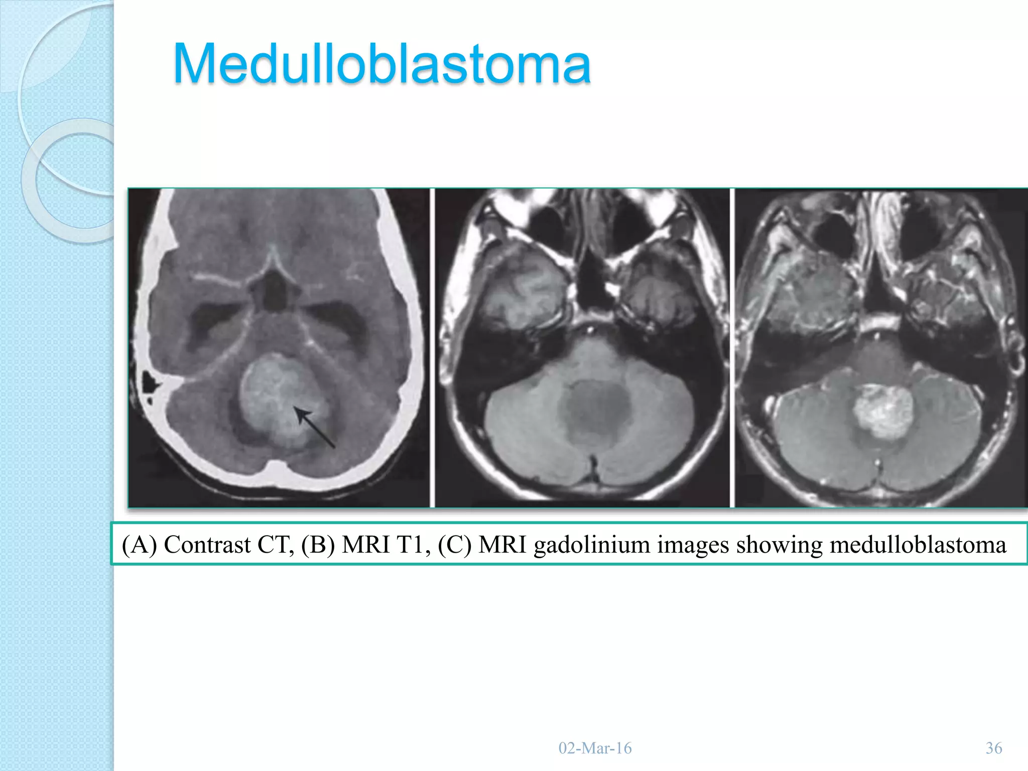 Intra axial posterior fossa tumor | PPTX