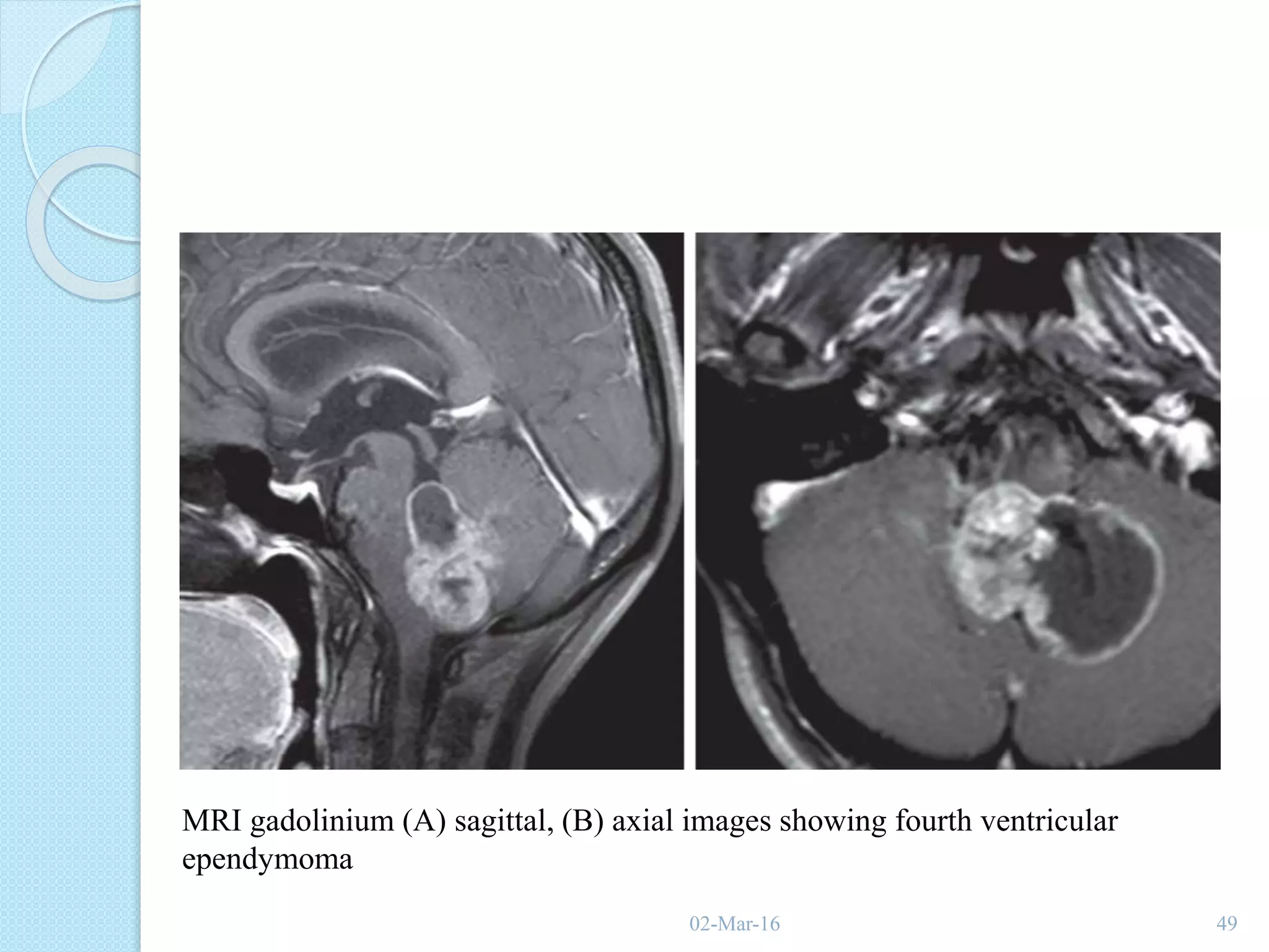 Intra axial posterior fossa tumor | PPTX