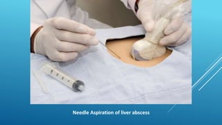 Intrabdominal abscess | PPTX