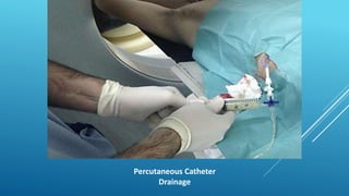 Intrabdominal abscess | PPTX