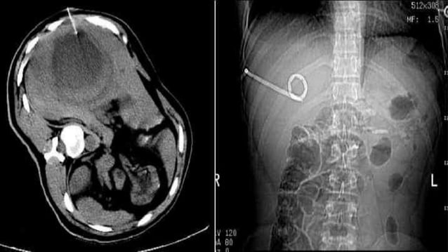 Intrabdominal abscess | PPTX