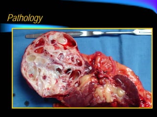 Intrabdominal renal mass | PPT