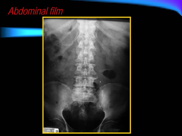 Intrabdominal renal mass | PPT