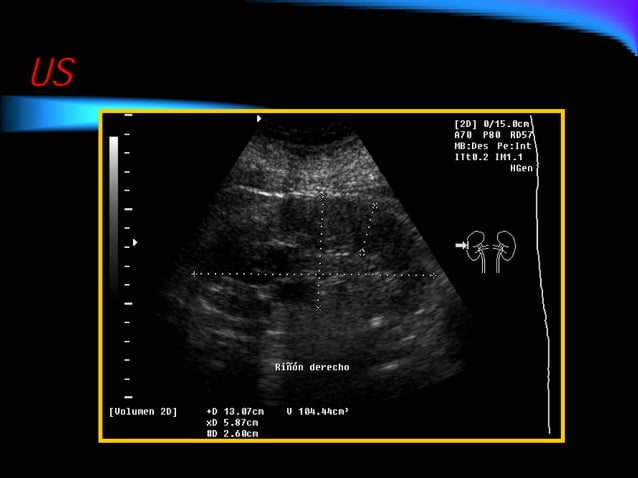 Intrabdominal renal mass | PPT