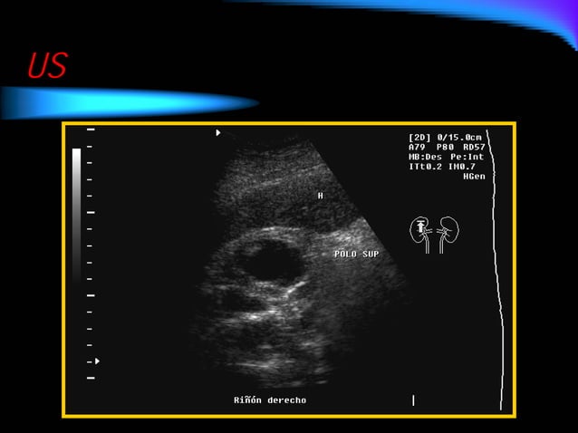 Intrabdominal renal mass | PPT