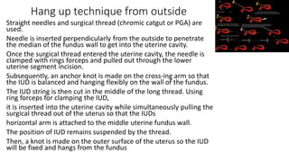 Intra caesarean loop (device or system ) insertion | PPTX