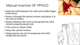 Intra caesarean loop (device or system ) insertion | PPTX