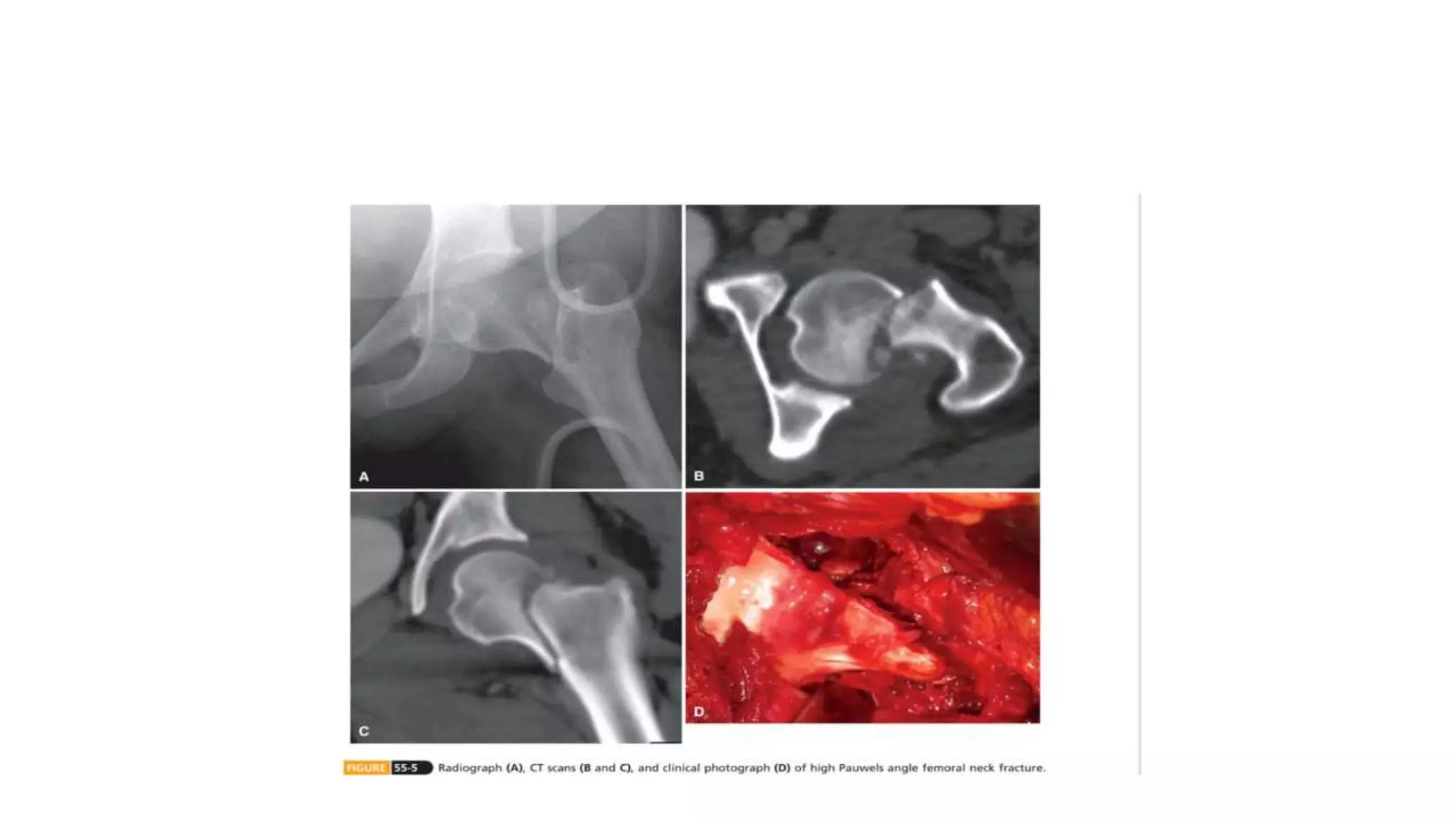 Intracapsular fracture neck of femur | PPTX