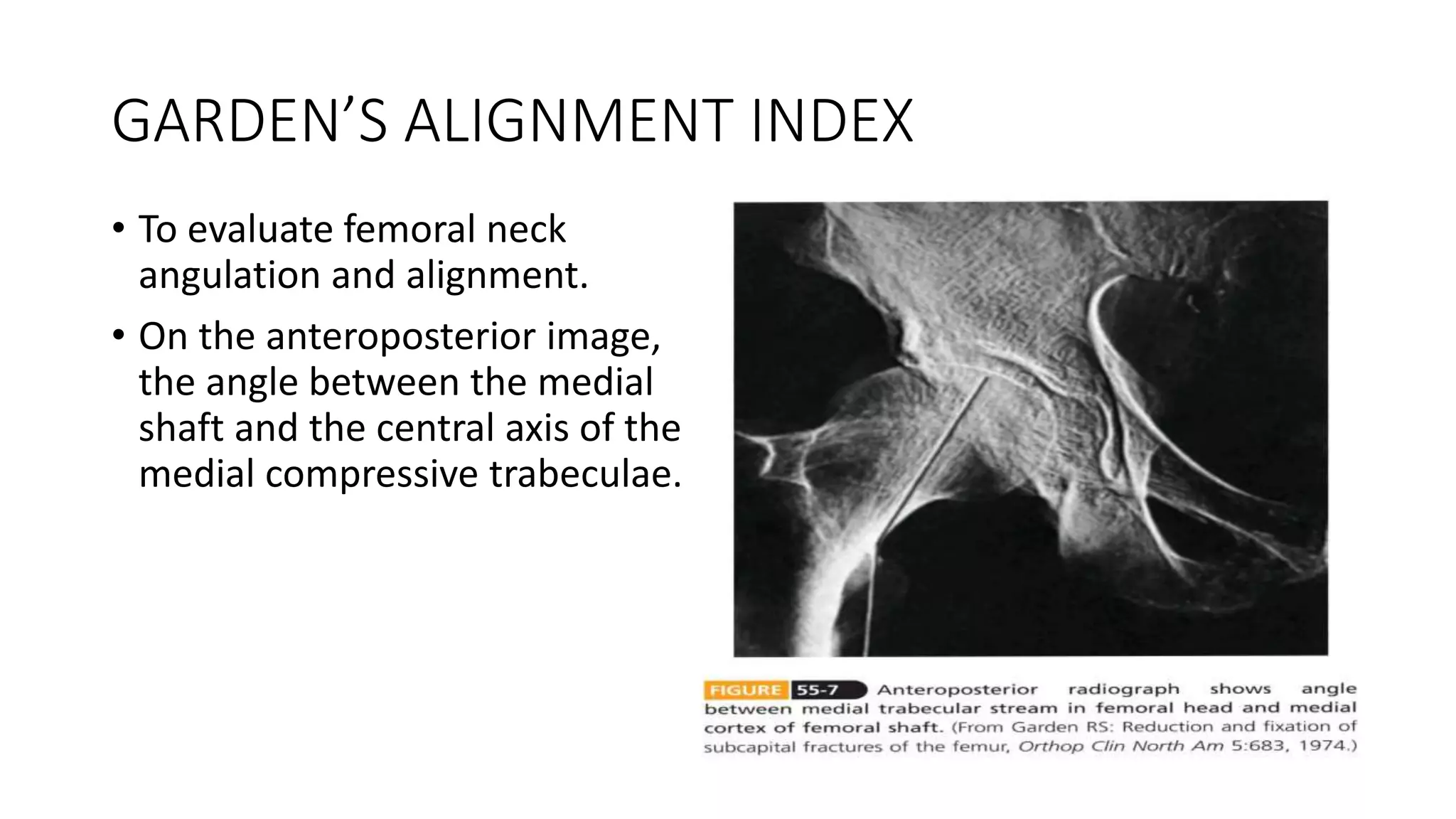 Intracapsular fracture neck of femur | PPTX