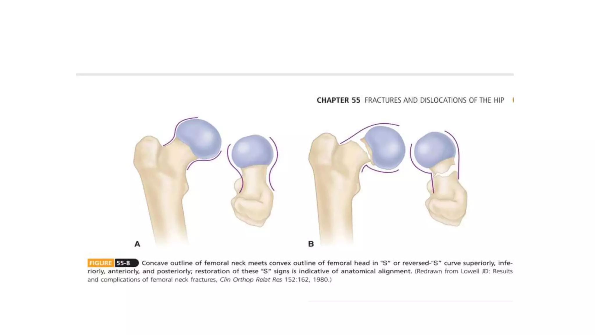 Intracapsular fracture neck of femur | PPTX