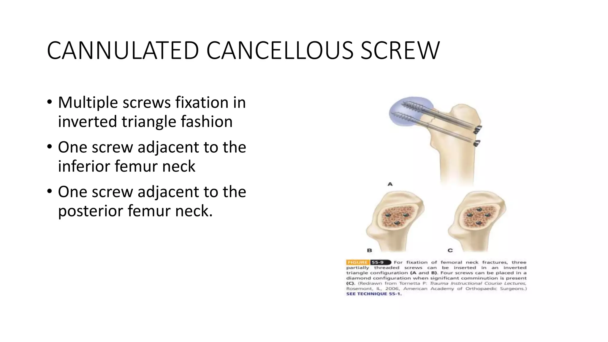 Intracapsular fracture neck of femur | PPTX