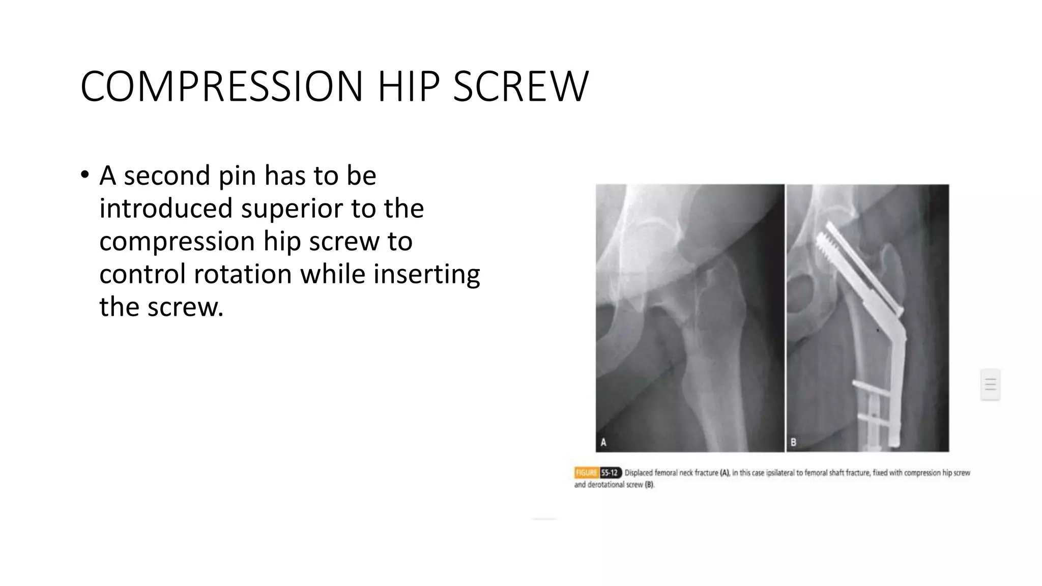 Intracapsular fracture neck of femur | PPTX
