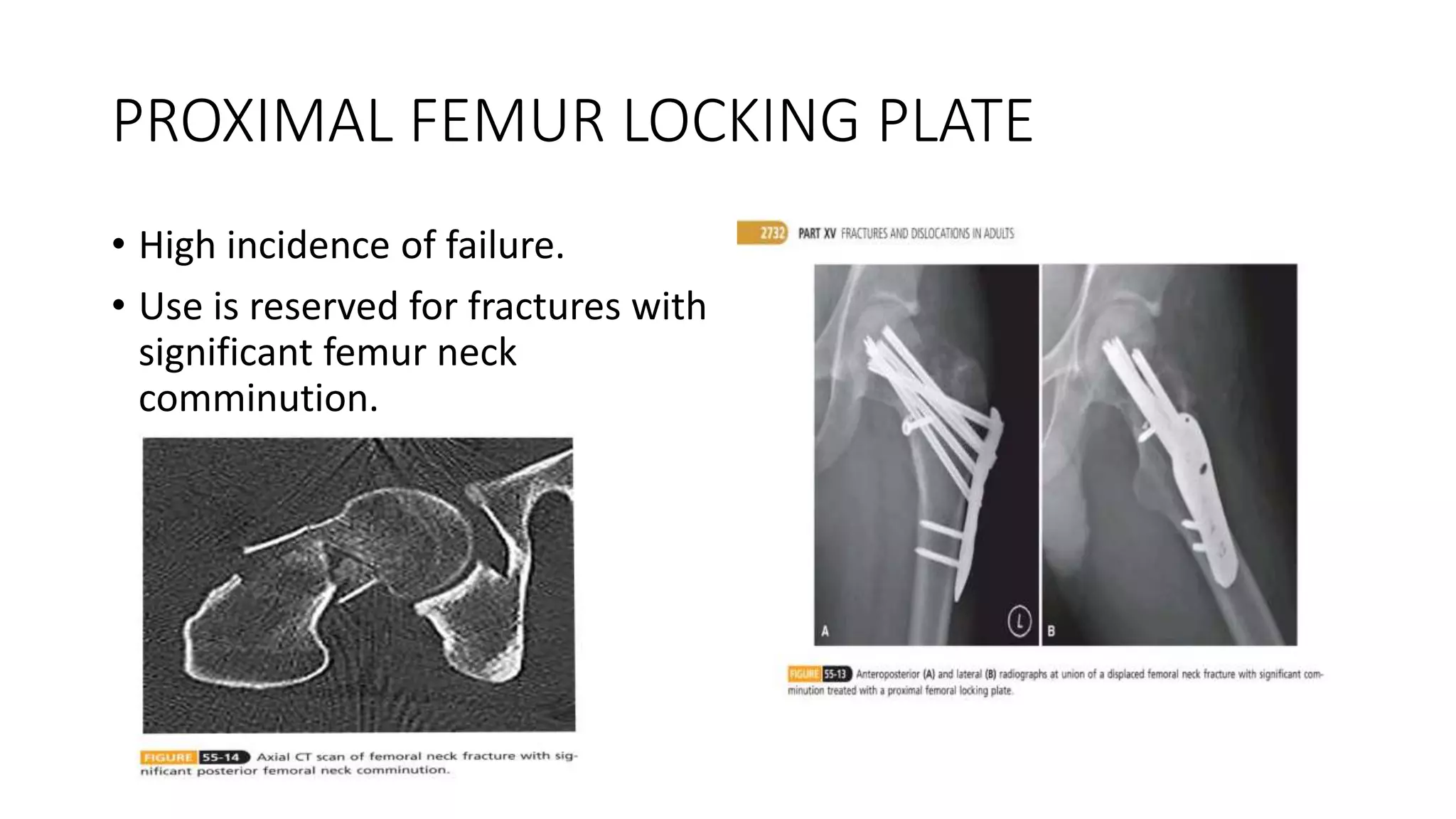 Intracapsular fracture neck of femur | PPTX