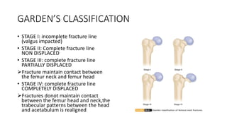 Intracapsular fracture neck of femur | PPTX
