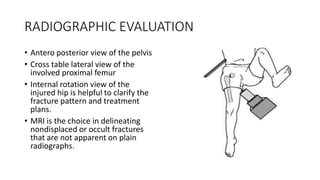 Intracapsular fracture neck of femur | PPTX