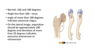 Intracapsular fracture neck of femur | PPTX