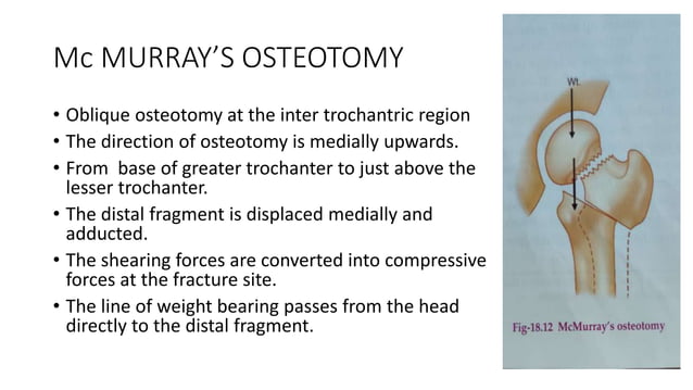 Intracapsular fracture neck of femur | PPTX | Death, Injury, or ...