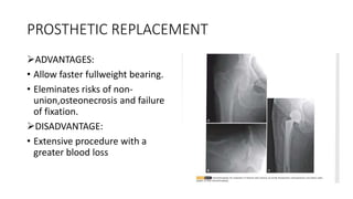 Intracapsular fracture neck of femur | PPTX