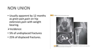 Intracapsular fracture neck of femur | PPTX