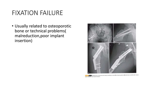 Intracapsular fracture neck of femur | PPTX | Death, Injury, or ...