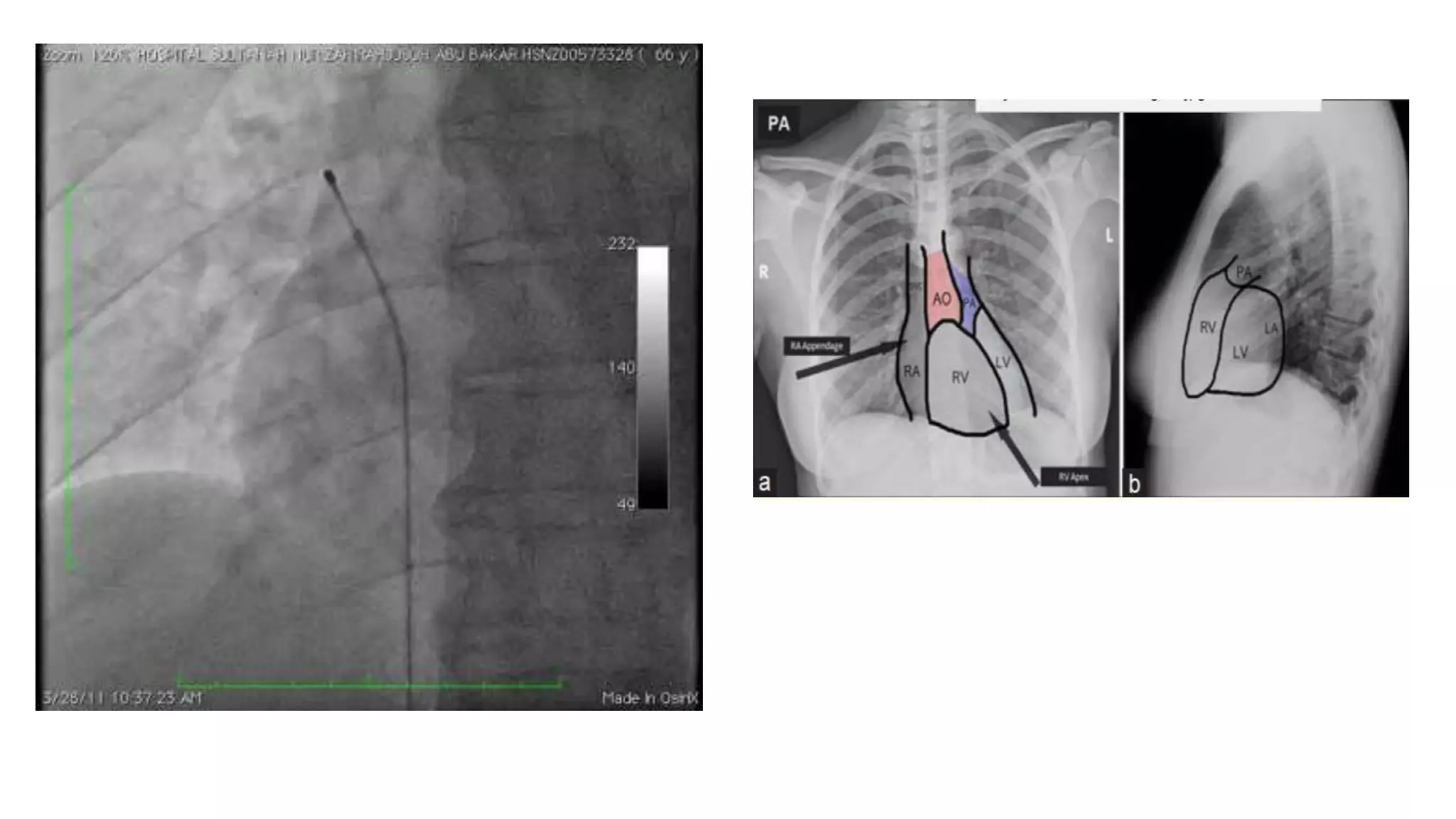 INTRACARDIAC DEVICES AND ITS COMPLICATION seminar..pptx