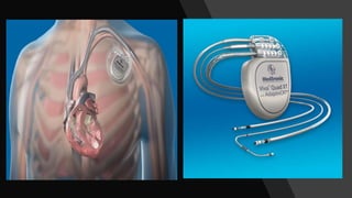 INTRACARDIAC DEVICES AND ITS COMPLICATION seminar..pptx