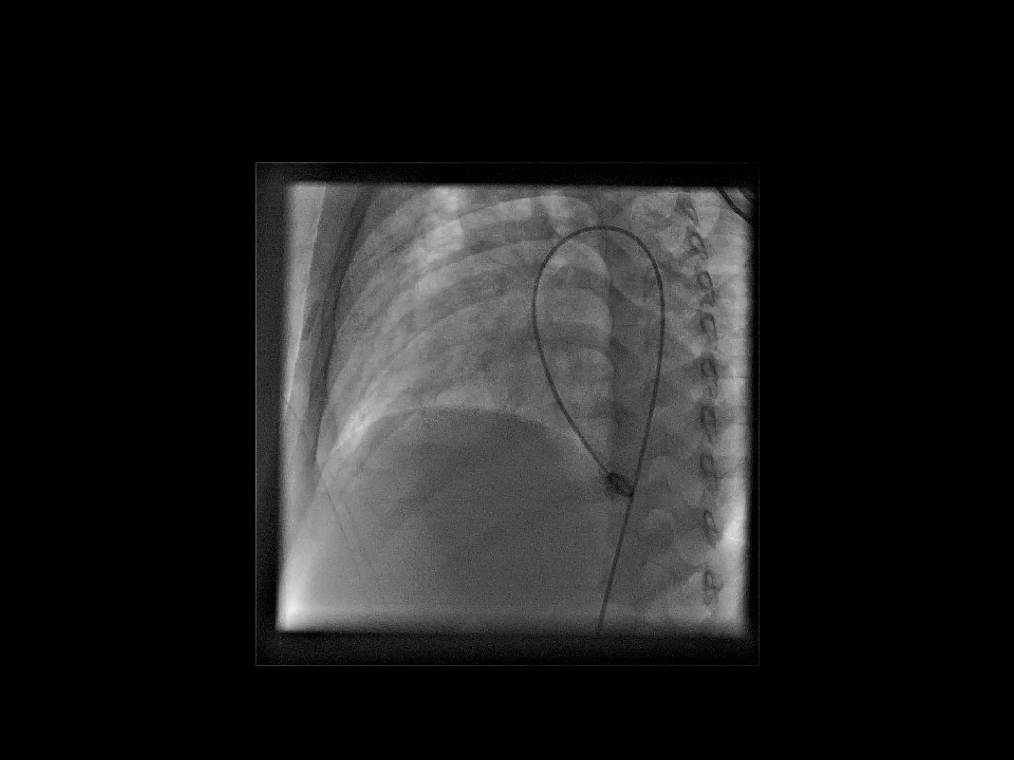 Intracardiac shunts | PPT