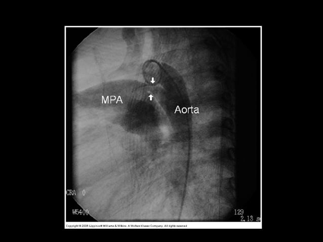 Intracardiac shunts | PPT | Heart and Cardiovascular Diseases ...