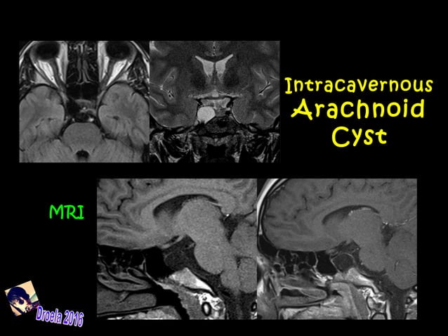 Intracavernous Arachnoid Cyst MRI | PPT