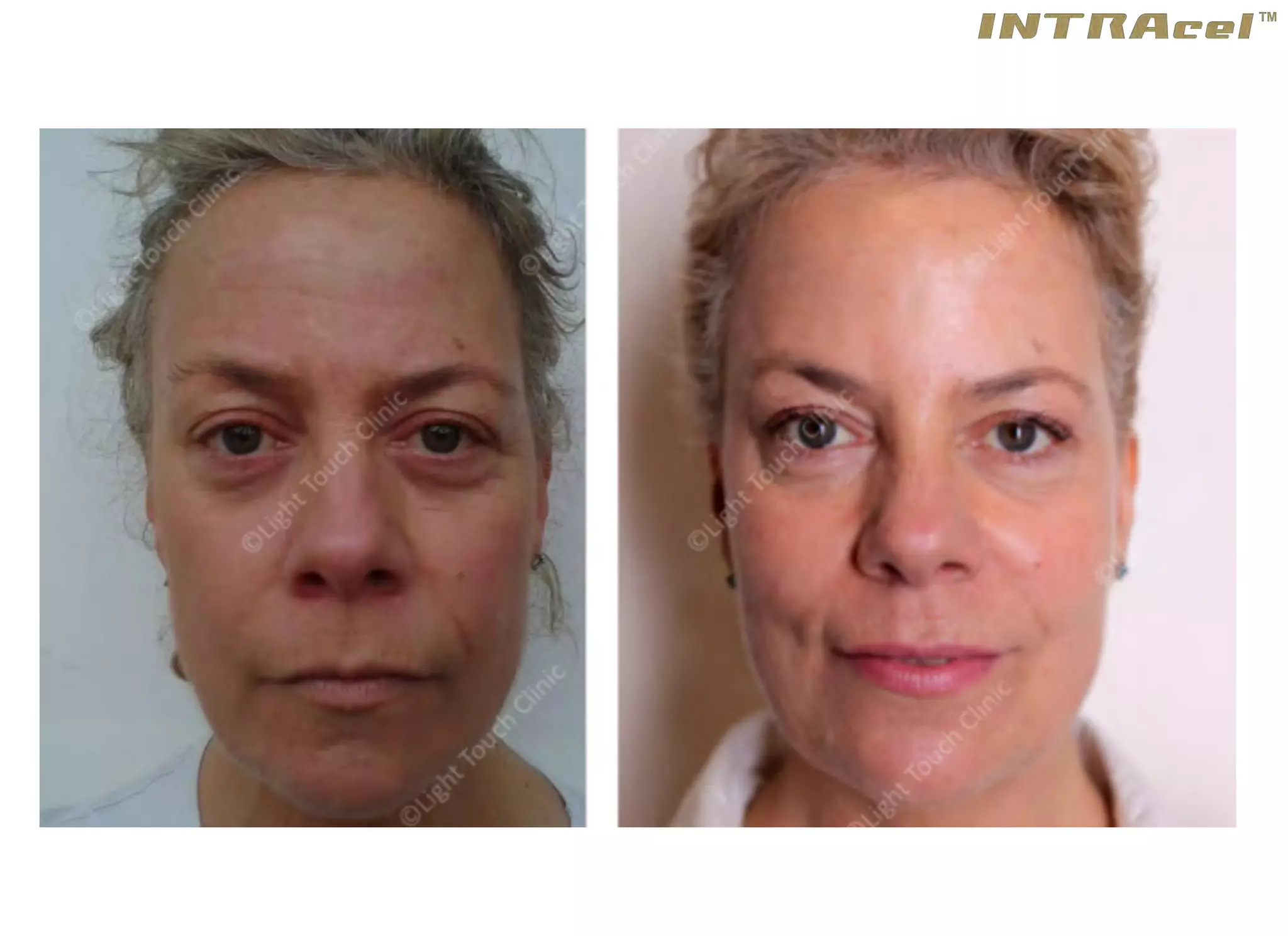INTRAcel before-and-after collection | PDF