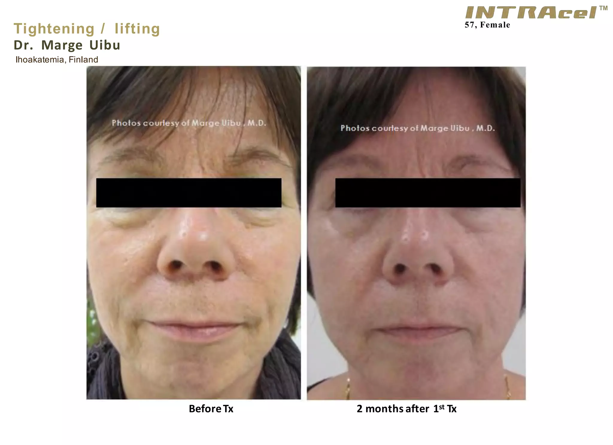 INTRAcel before-and-after collection | PDF