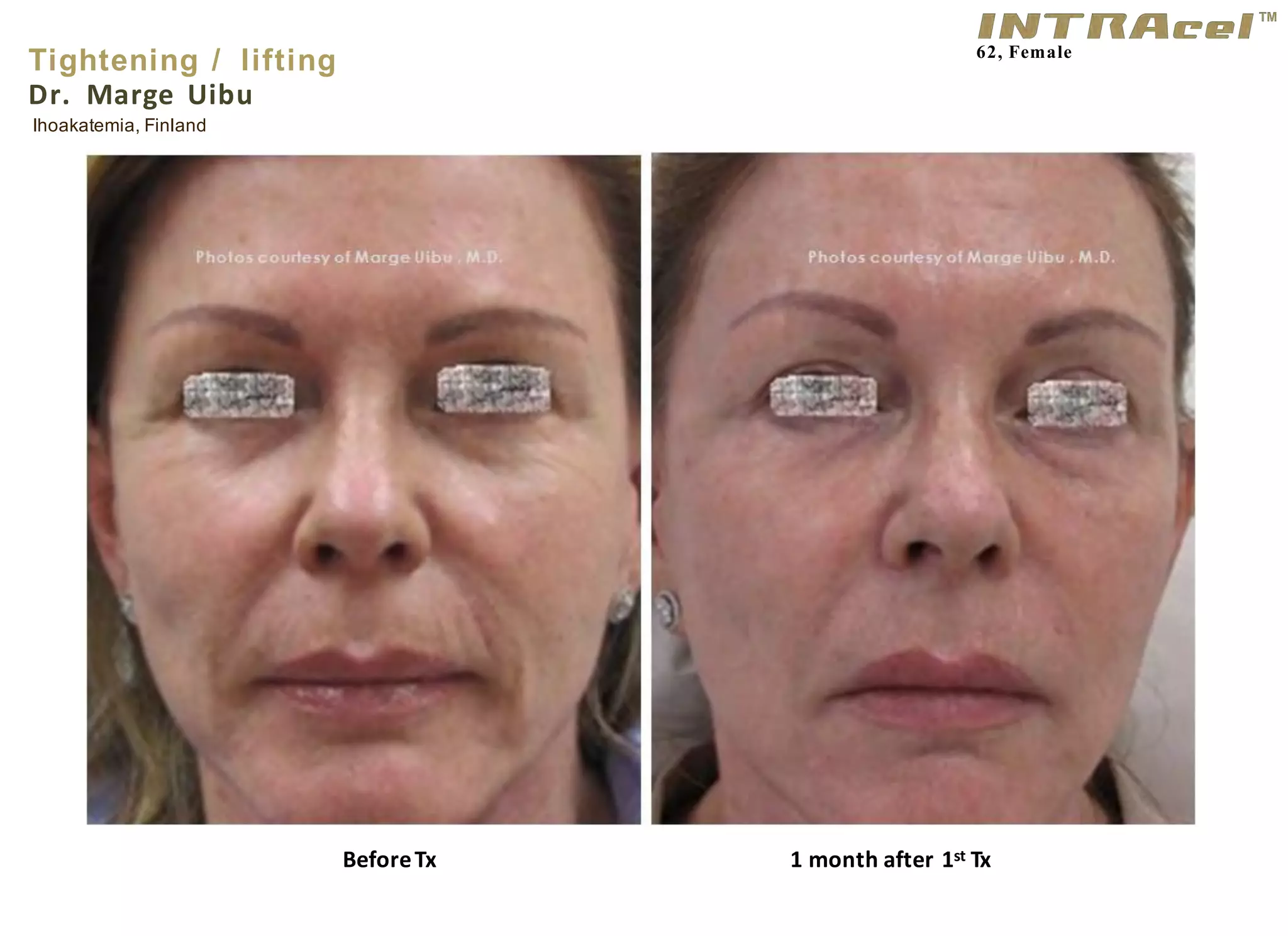 INTRAcel before-and-after collection | PDF