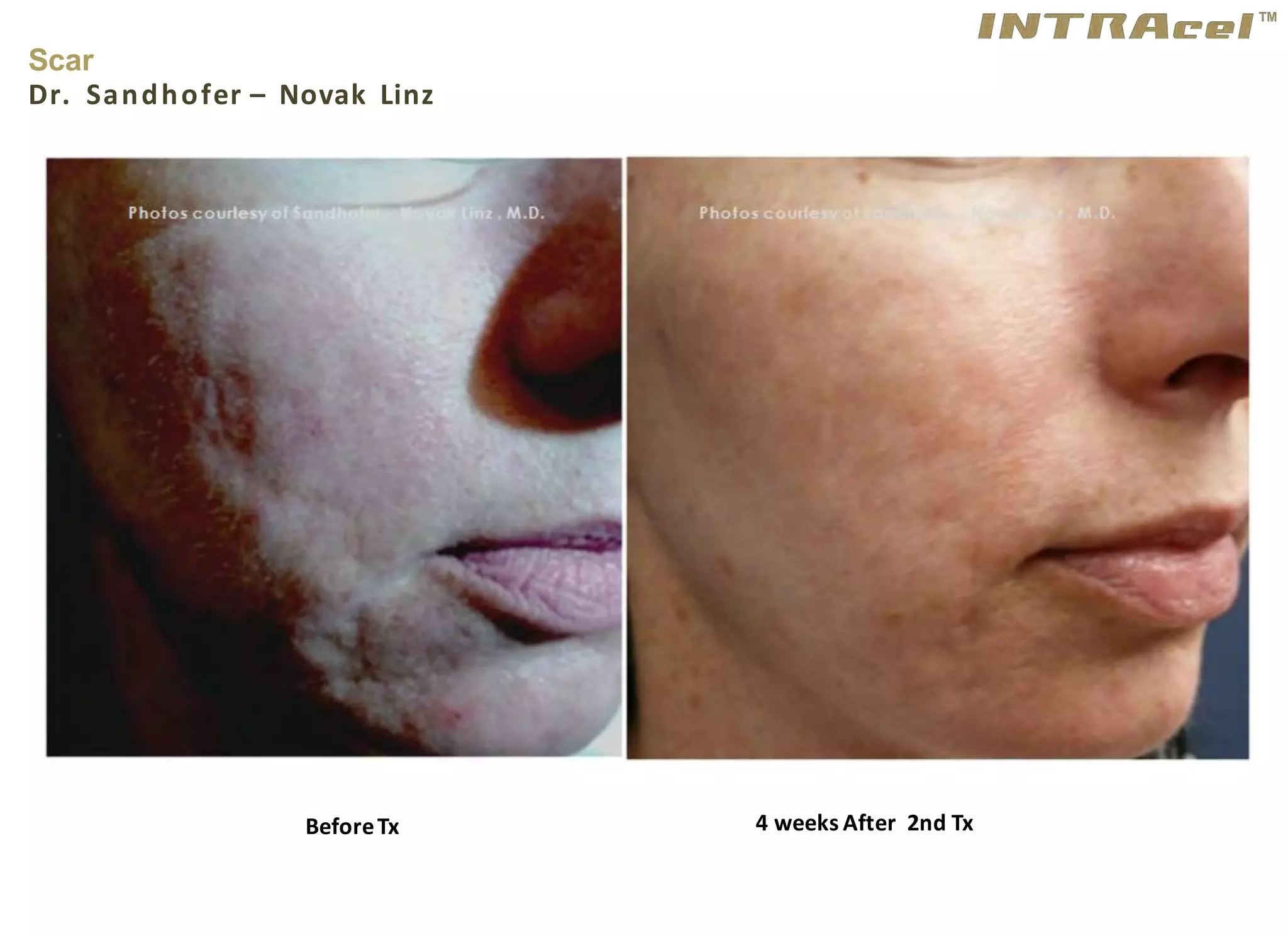INTRAcel before-and-after collection | PDF