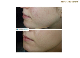 INTRAcel before-and-after collection | PPT